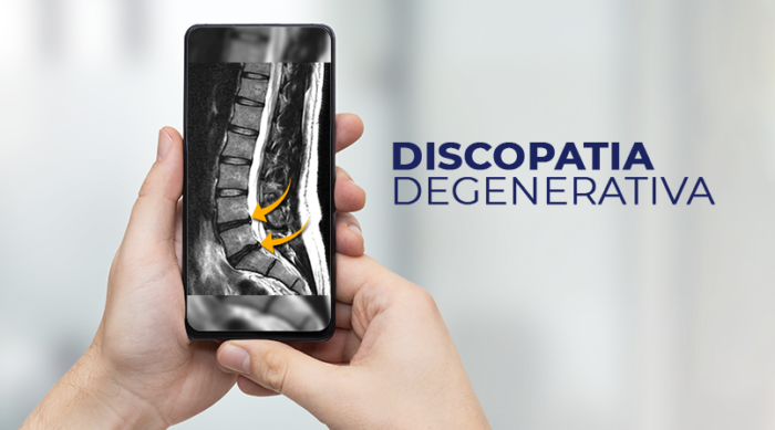Discopatia degenerativa - Dr. Lohran Anguera Lima